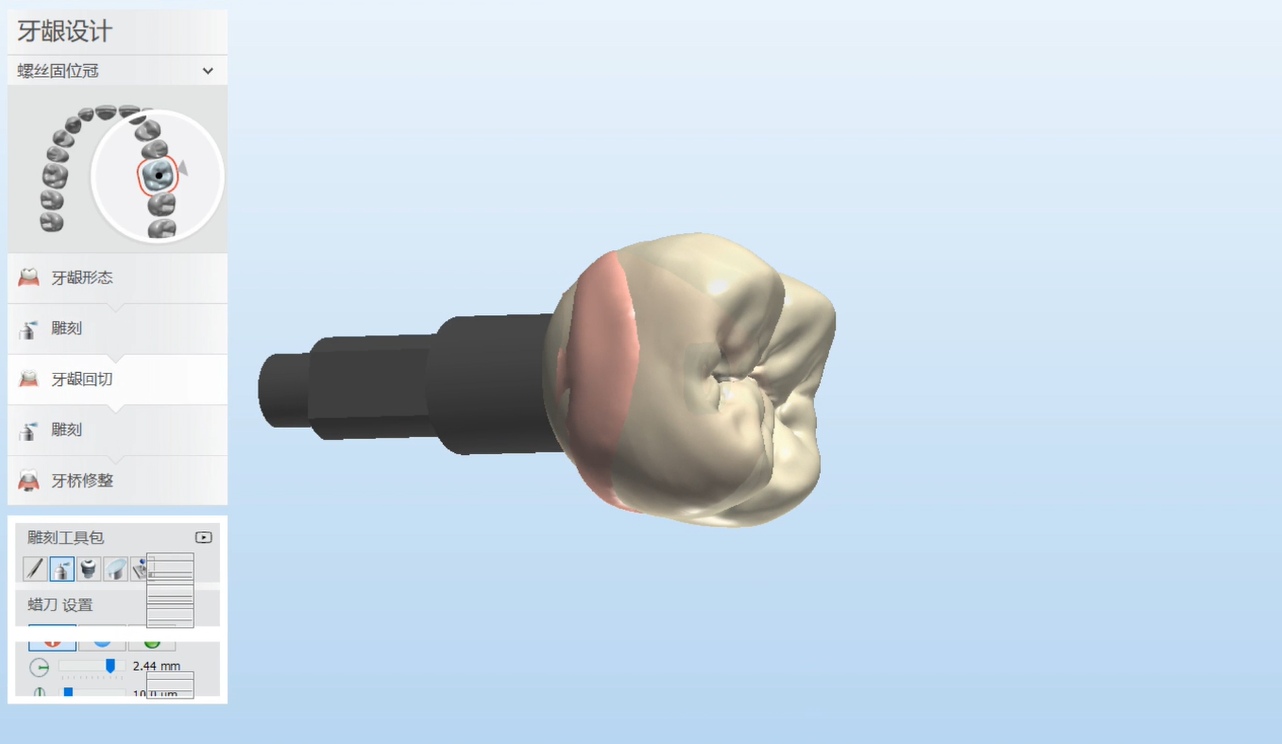 3shape马龙桥的设计_医疗器具_诊断治疗_3Shape_口腔-仿真秀视频课程